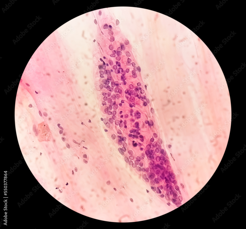 Microscopic view of Trichomonas vaginalis in pap smear with few acute ...