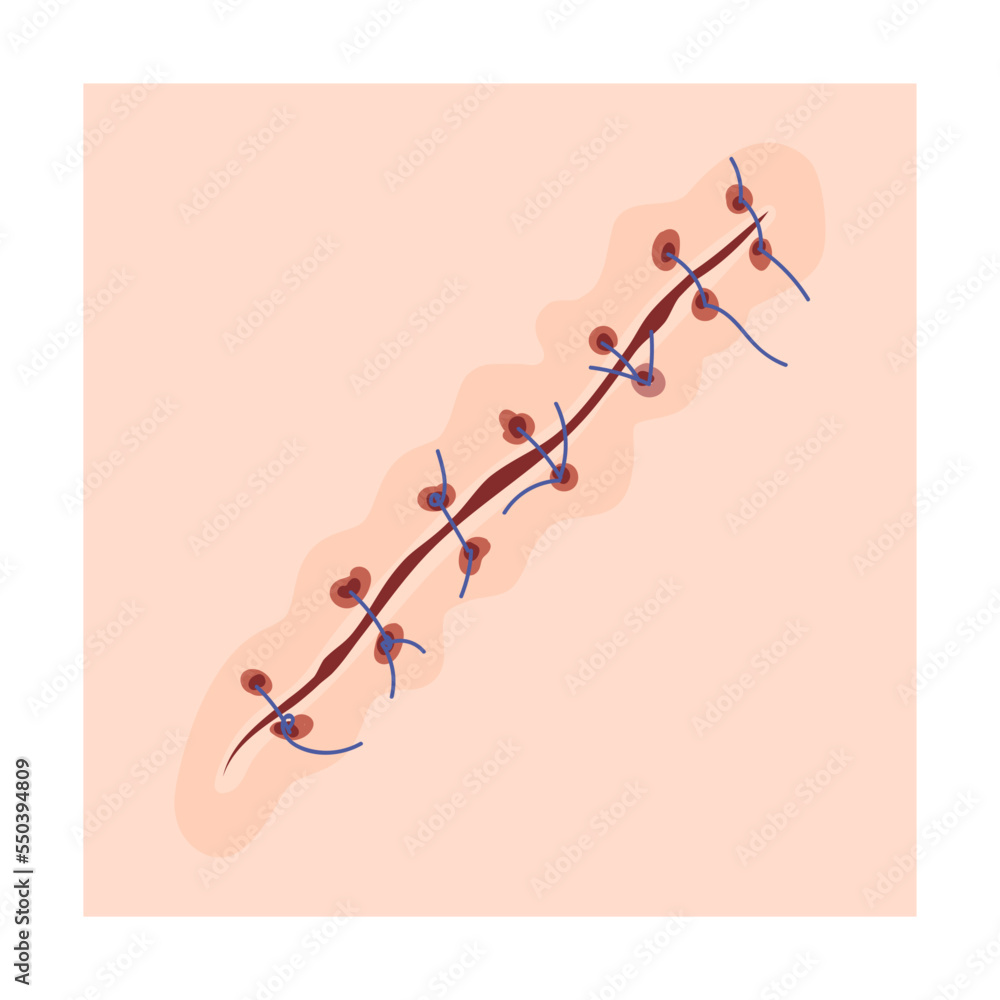 Skin scar with seam cartoon illustration. Bloody wound, injures ...