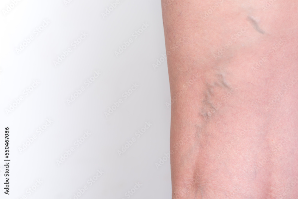 varicose veins, leg veins, back view of a woman, back view of a woman ...