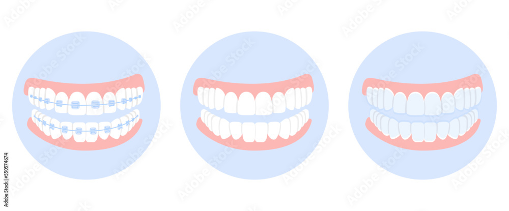 Braces, mouthguards, and aligners for correction jaw and teeth, in blue ...