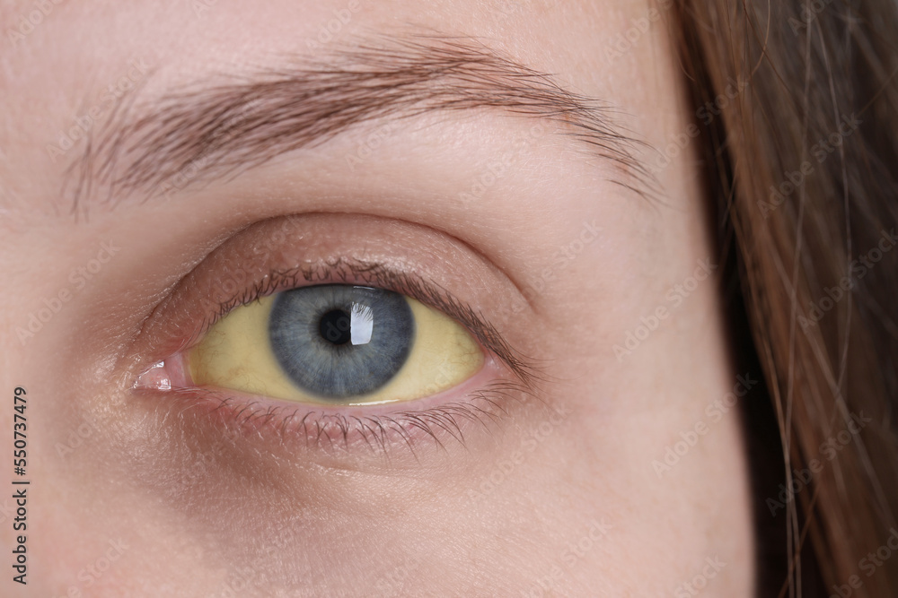 Woman with yellow eyes, closeup view. Symptom of hepatitis Stock Photo ...