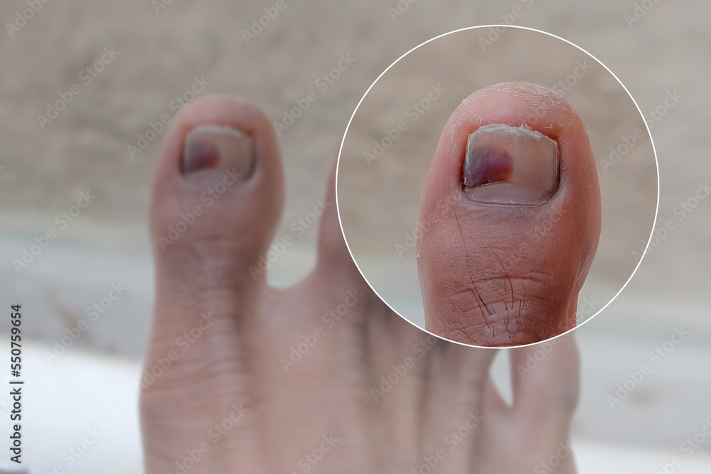 Bruised and damaged male nails from impact. Concept illustration of ...