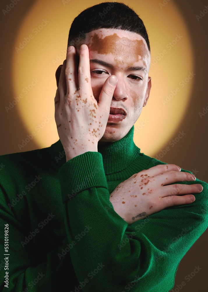 Vitiligo, man face and fashion model portrait for luxury beauty, style ...