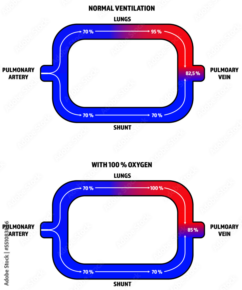 A diagram of how a pulmonary shunt works Stock Vector | Adobe Stock