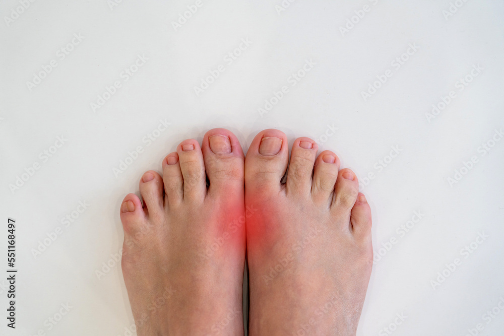 Feet disease Rheumatism and gout. Painful gout inflammation on big toe ...
