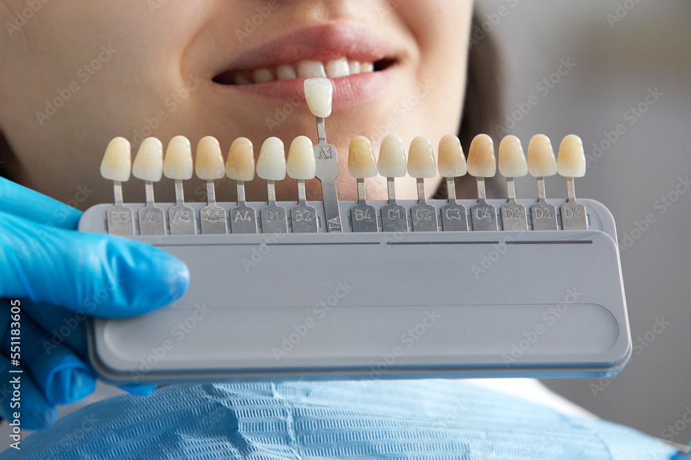 Dentist choosing color tone of tooth enamel for patient. Dentist ...
