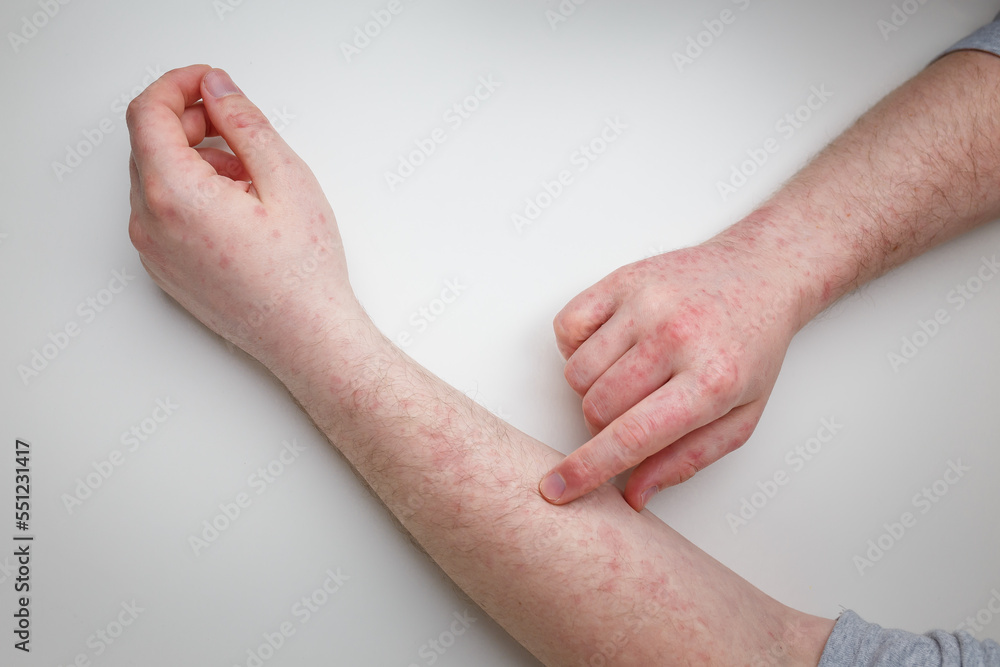Itchy Rash On Hands Nhs at William Fellows blog