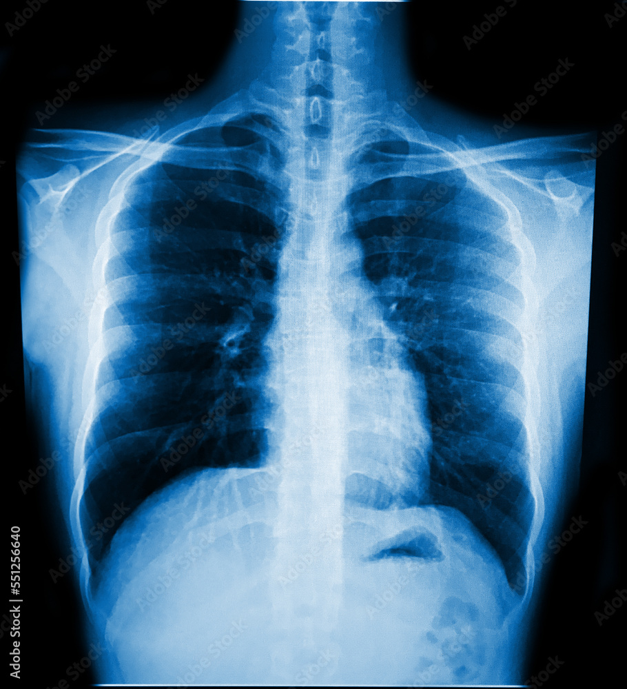 X-Ray Image Of Human Chest for a medical diagnosis Stock Photo | Adobe ...