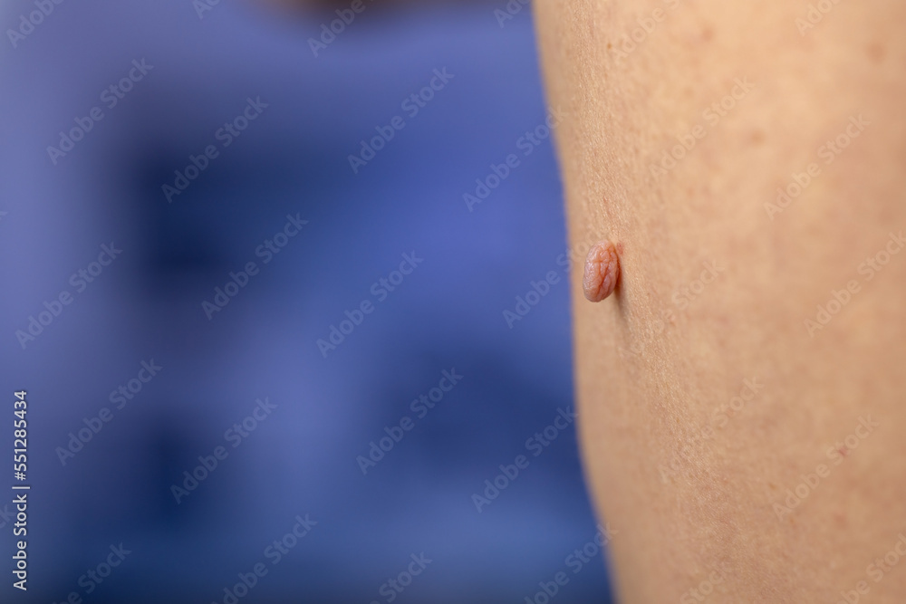 Close-up of large rashes or smallpox on the skin of an adult male ...