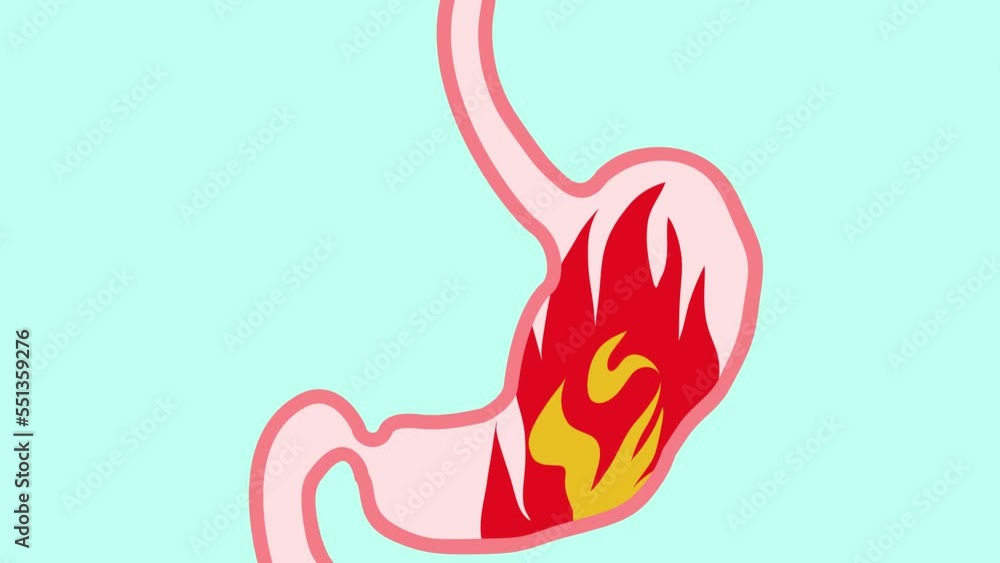 Realistic medical illustration of pyrosis stomach isolated. Fire ...