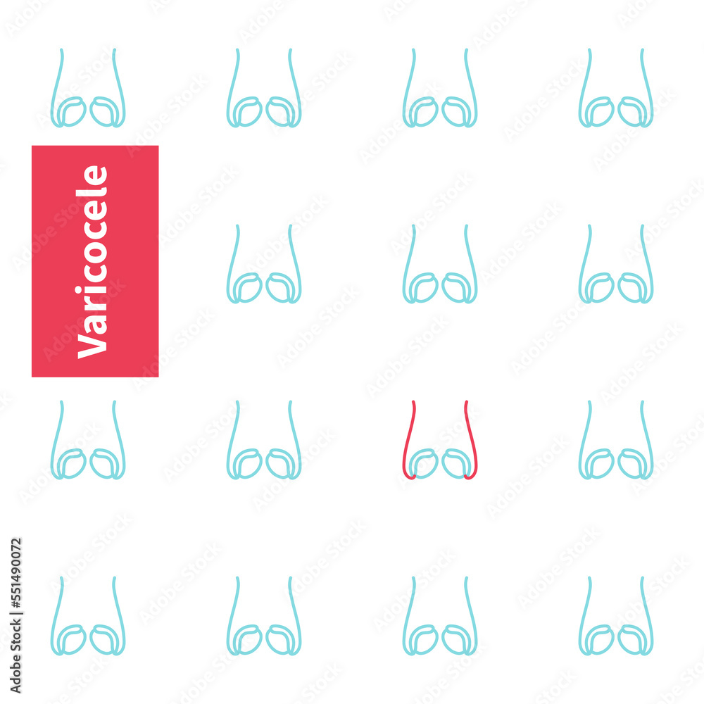 Varicocele disease awareness. Scrotum veins enlargement. Testes pattern ...