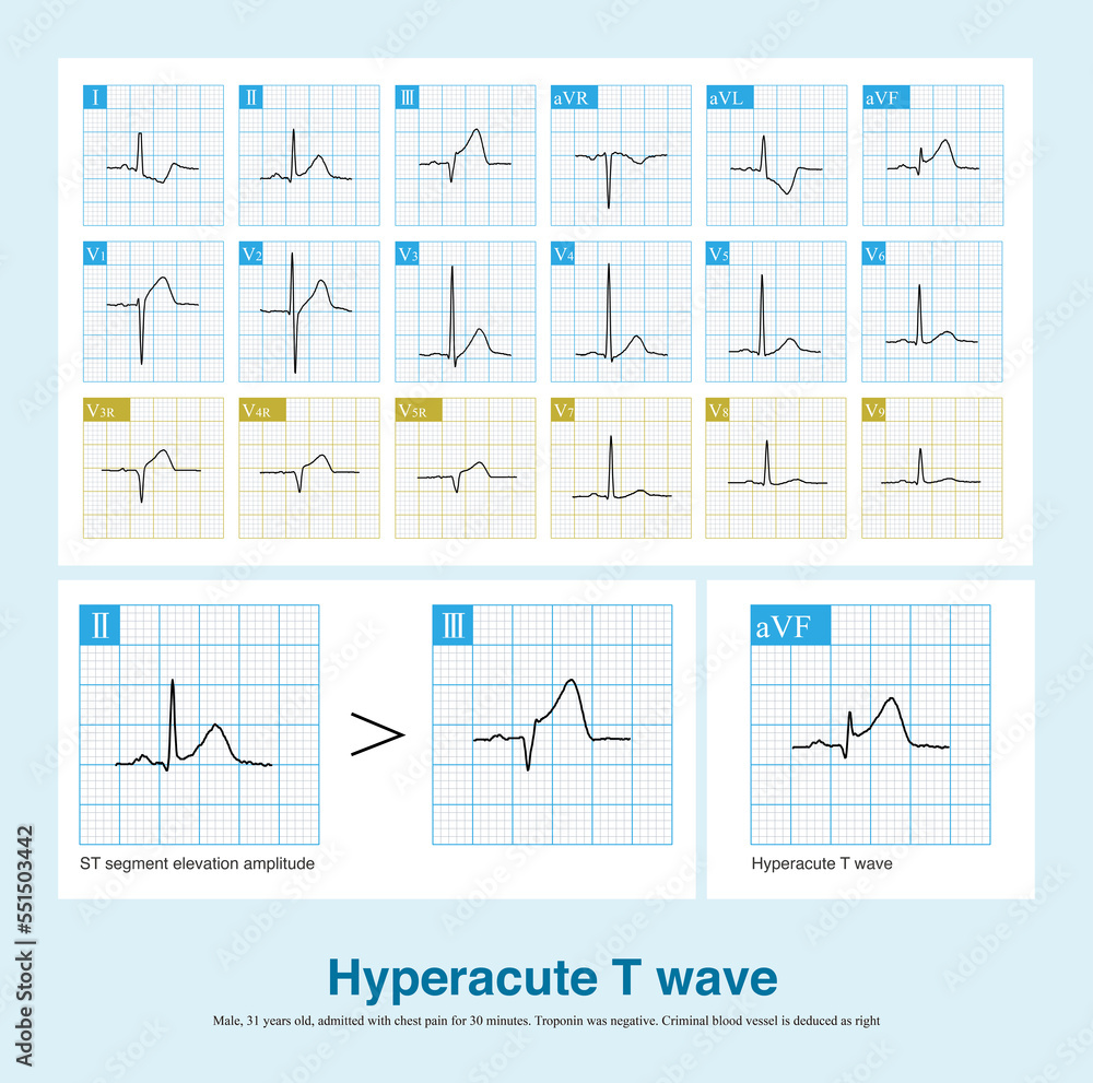 In the early stage of acute myocardial infarction, T wave is upright ...