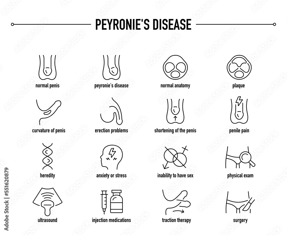 Poster Peyronie's Disease symptoms, diagnostic and treatment vector ...
