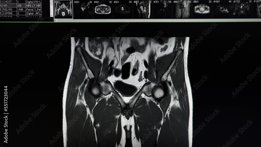 Hip MRI scan showing left side pyomyositis and intramuscular abscess at ...