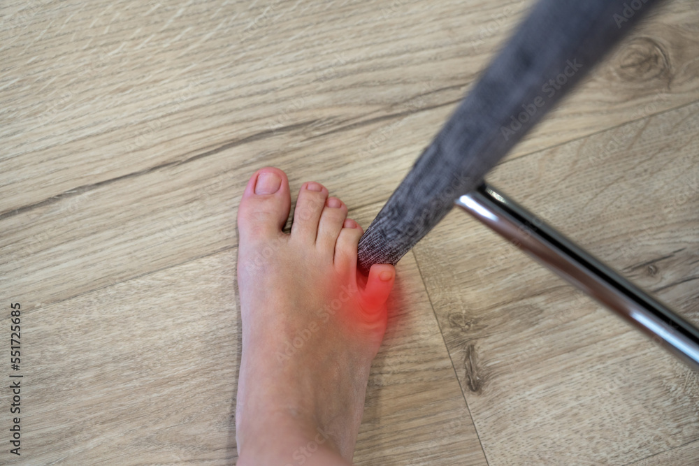 Woman hit chair with the little toe. Incident at home. Red spot showing ...