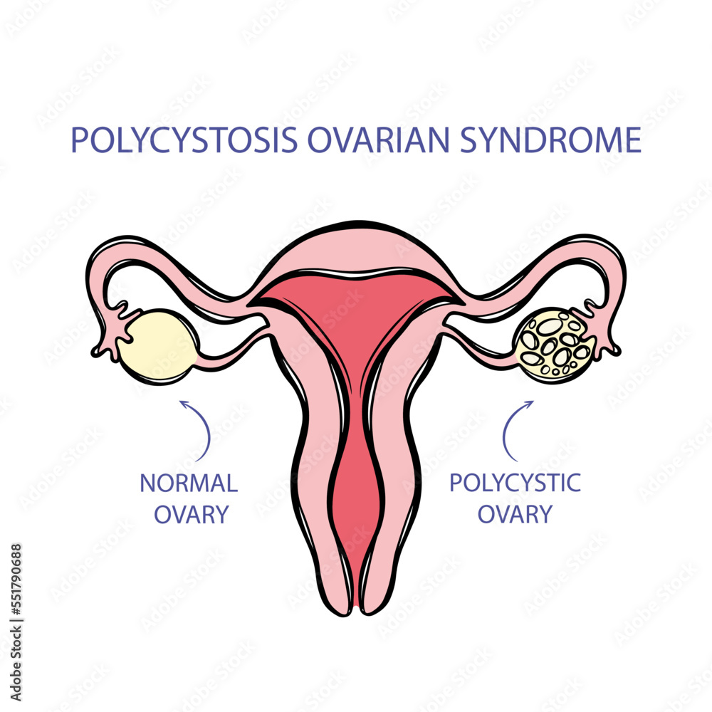 POLYCYSTOSIS OVARIAN SYNDROME Female Reproductive System Cells Similar ...