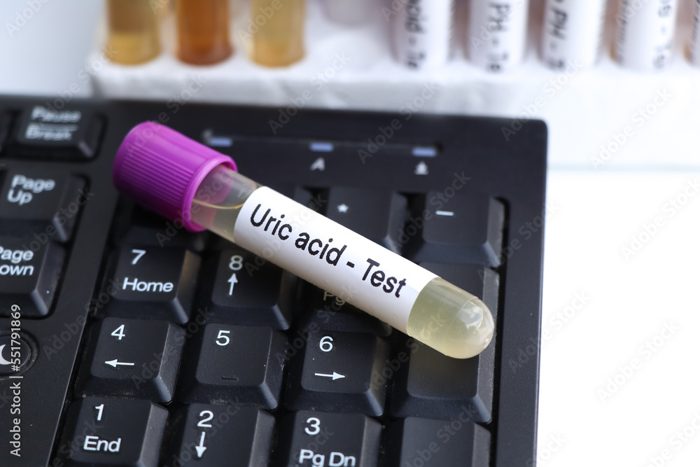 Uric acid test to look for abnormalities from Urine, Urine sample to ...
