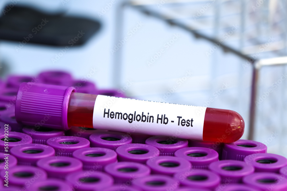 Foto de hemoglobin hb test to look for abnormalities from blood, blood ...