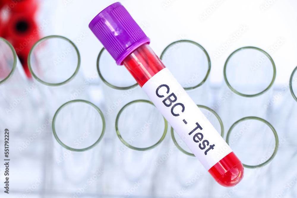 CBC test to look for abnormalities from blood, blood sample to analyze ...