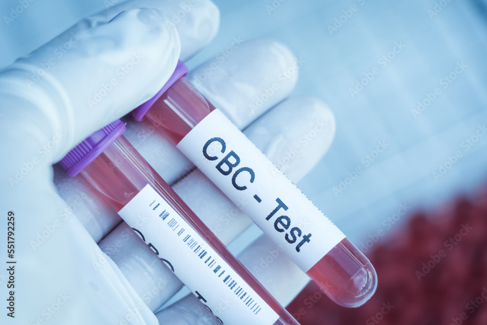 CBC test to look for abnormalities from blood, blood sample to analyze ...