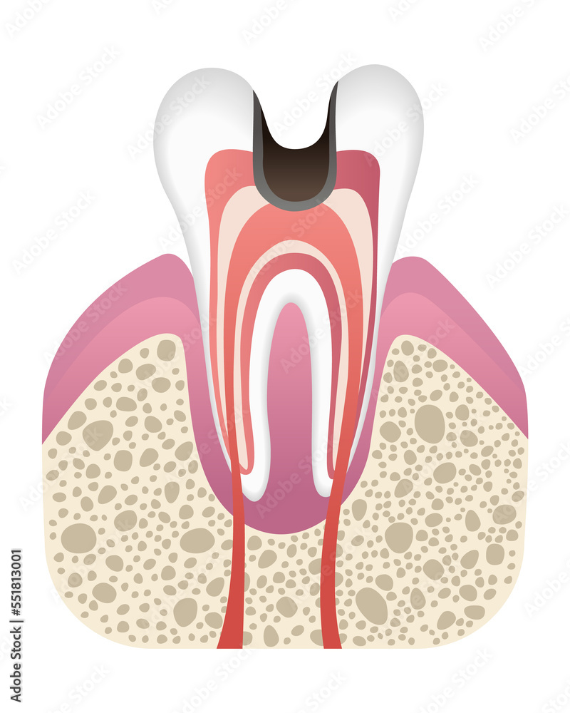 Stage of caries development. Tooth structure in flat style. Tooth decay ...