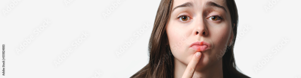Virus herpes on lips close-up. Unhappy woman shows on a painful swollen ...