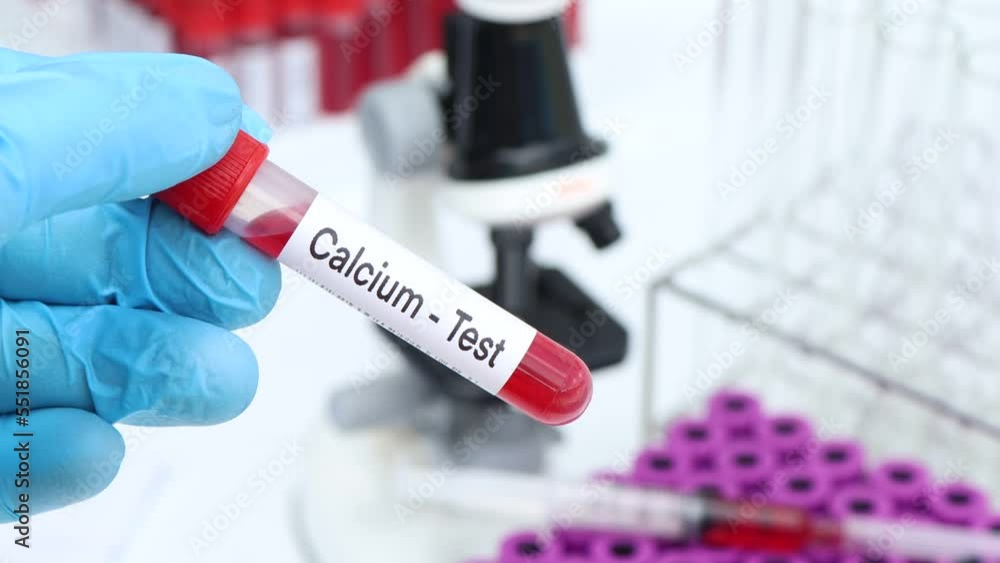 calcium test to look for abnormalities from blood, blood sample to ...