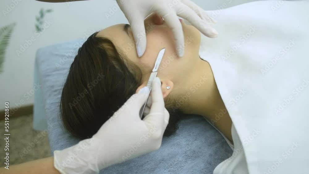 skin treatment with the dermaplaning technique performed with a scalpel ...