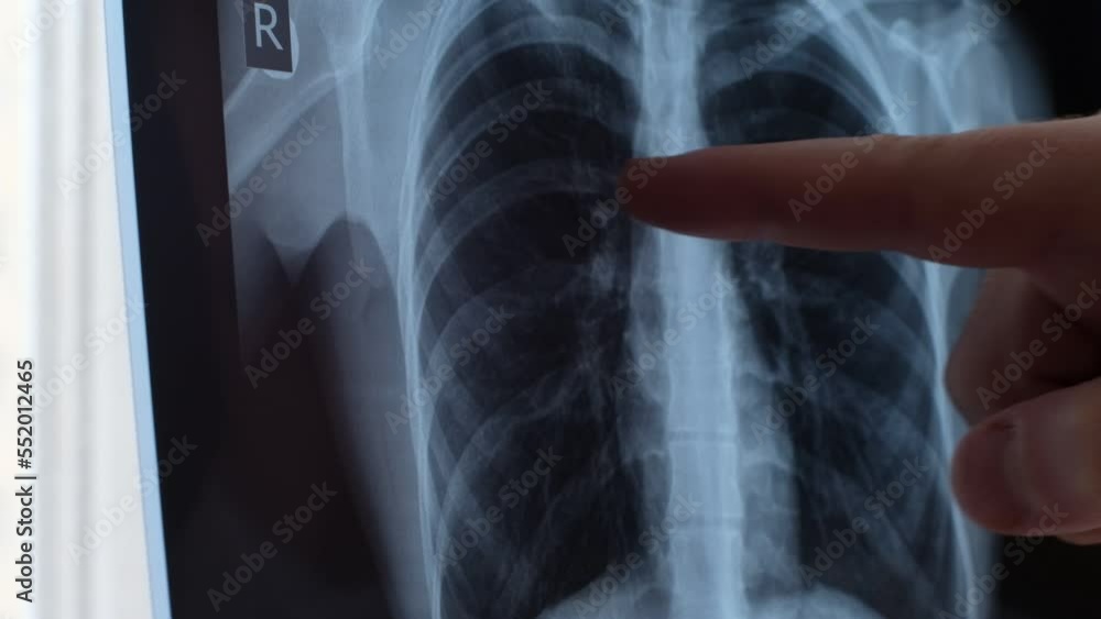 Lung radiography concept. Radiology doctor examining at chest x ray ...