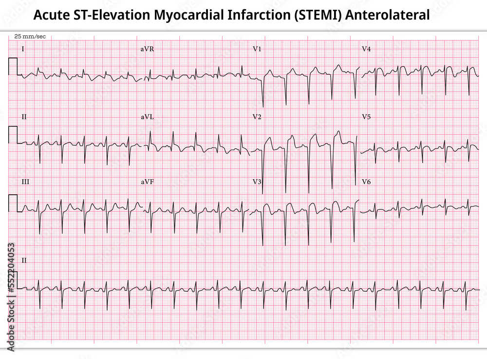 ECG Acute ST-Elevation Myocardial Infarction (STEMI) Anterolateral ...