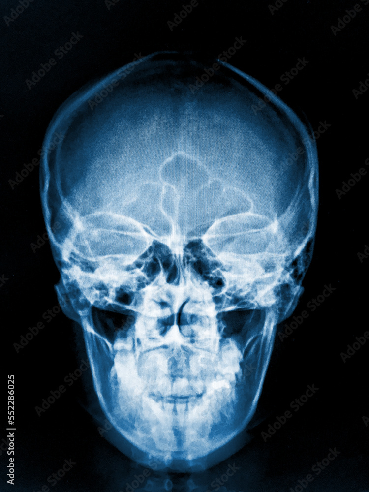 x ray of human skull Stock Photo | Adobe Stock