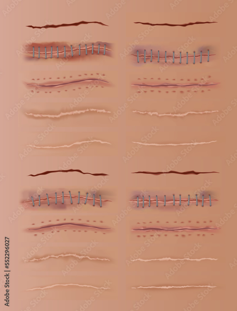 Healing wounds set, skin scars, stitched gash and cuts. Realistic ...