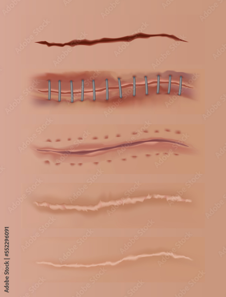 Healing wounds set, skin scars, stitched gash and cuts. Realistic ...