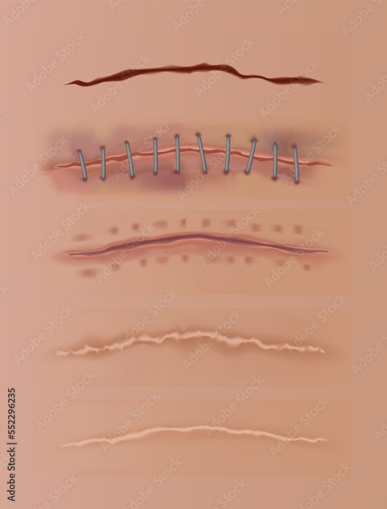 Healing wounds set, skin scars, stitched gash and cuts. Realistic ...