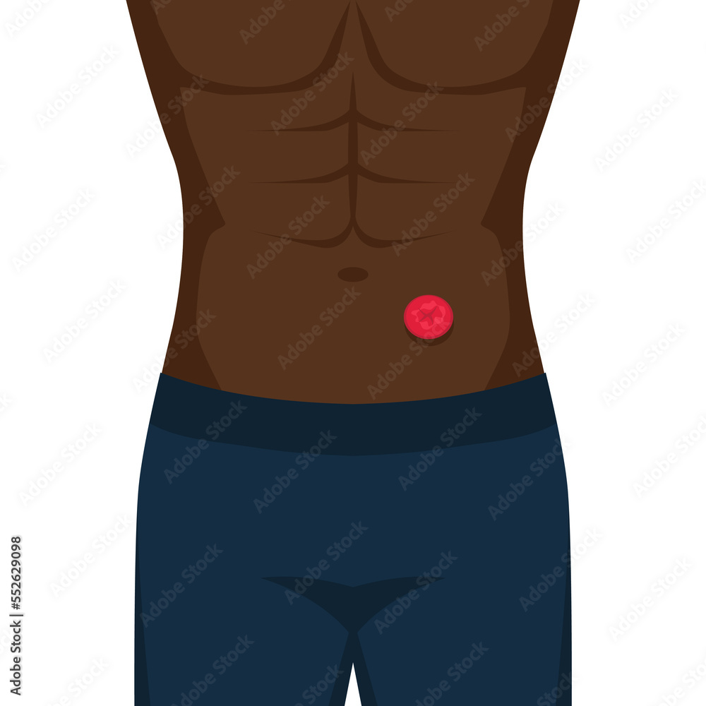 Black man with stoma after colon cancer surgery. Vector illustration ...