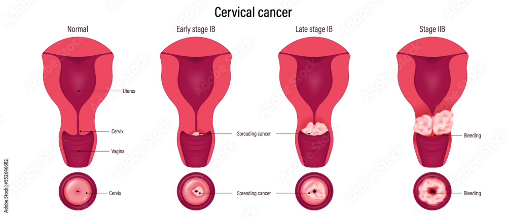 Cervical cancer development. cervix carcinoma stages. Female ...