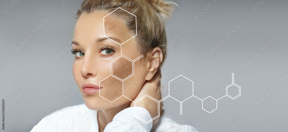 Dark spots, freckles,hyperpigmentation(melasma or chloasma),concept ...