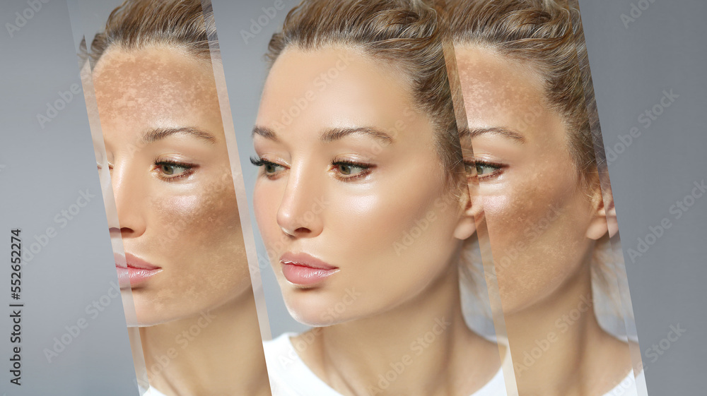 Dark spots, freckles,hyperpigmentation(melasma or chloasma),concept ...