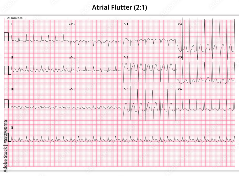 ECG Atrial Flutter (2:1) - ECG Paper 12 Lead Stock Vector | Adobe Stock