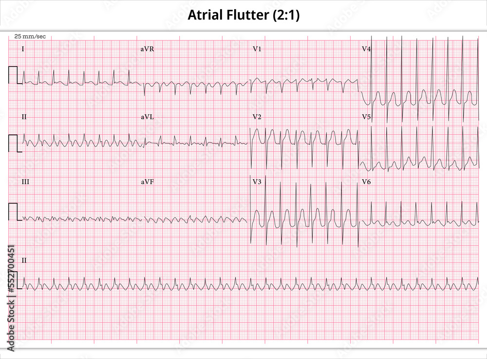 Atrial Flutter (2:1) - ECG Paper 12 Lead Stock Illustration | Adobe Stock