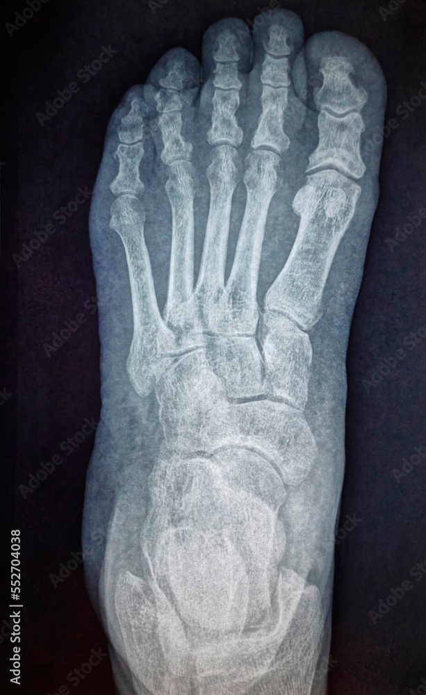 X-ray image of foot, radiography of food bones. Stock Photo | Adobe Stock