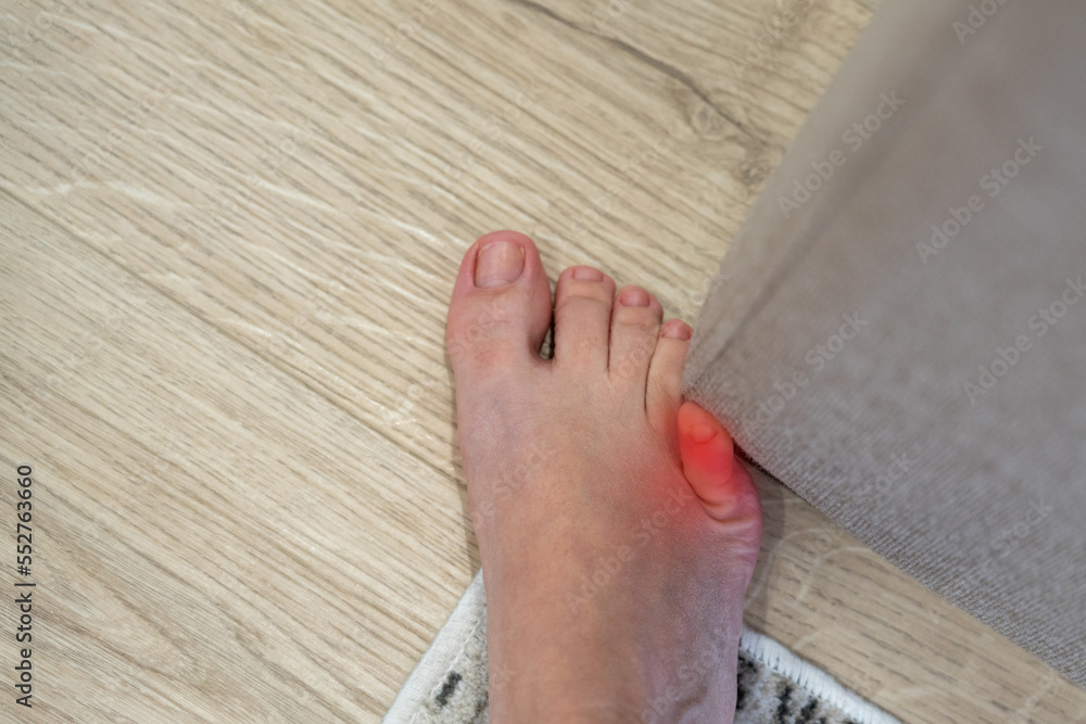 Woman hit furniture with the little toe. Incident at home. Red spot ...
