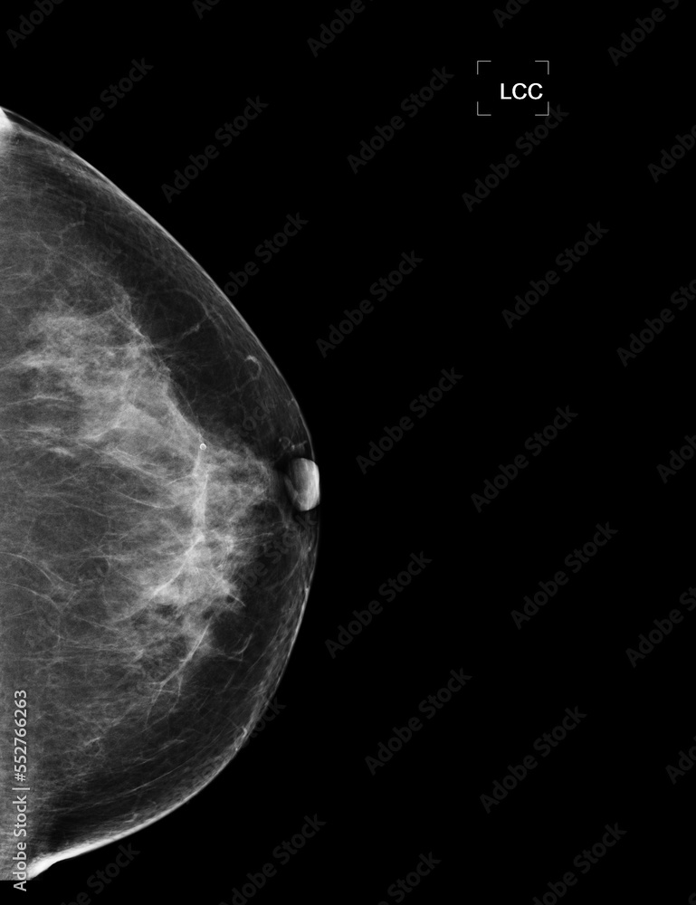 X-ray Digital Mammogram or mammography of both side breast showing ...