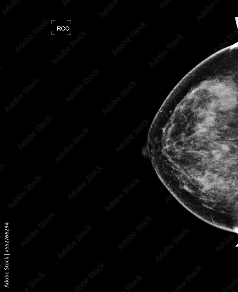 Foto de X-ray Digital Mammogram or mammography of both side breast ...