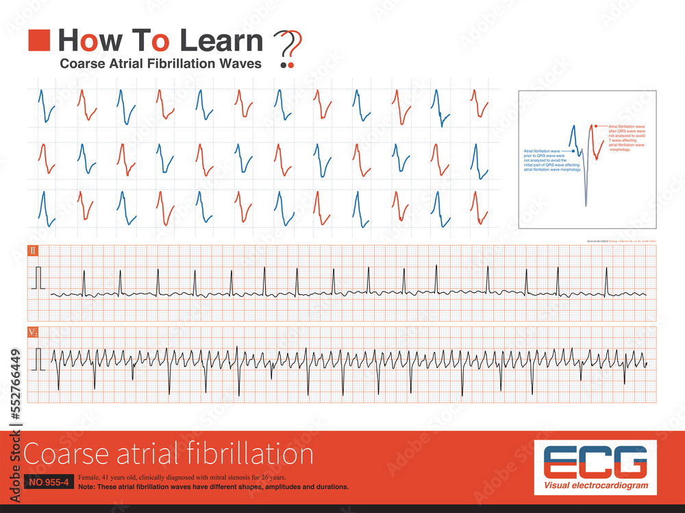 Sometimes, coarse atrial fibrillation is easily misdiagnosed as atrial ...