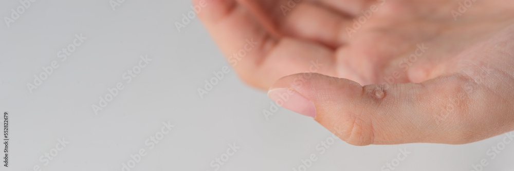 Wart on hand. The concept of treating warts and other skin defects ...