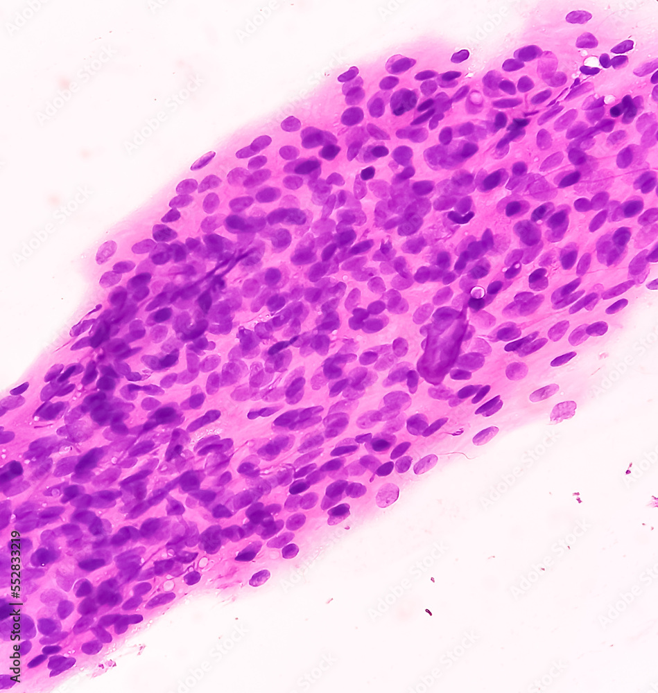 Pap's smear. Microscopic showing inflammatory smear with early atrophic ...