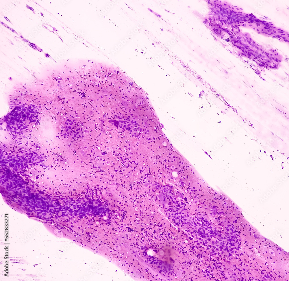 Pap's smear. Microscopic showing inflammatory smear with early atrophic ...
