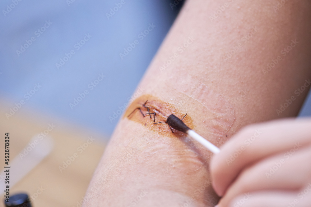 surgical suture wound on the arm treatment of the wound with iodine ...