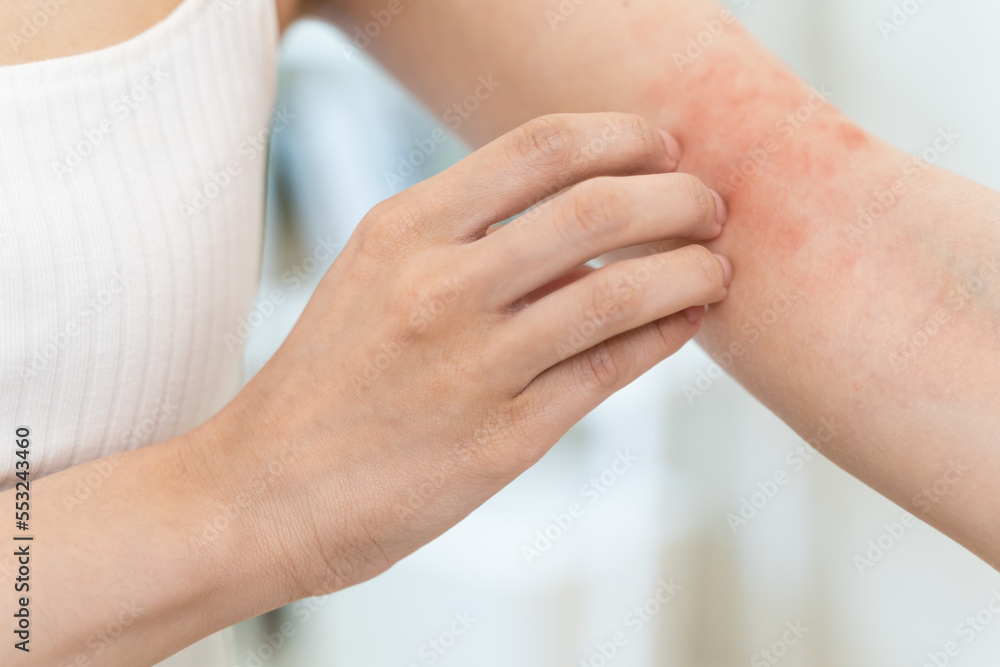 Póster Sensitive skin allergic concept, Woman itching on her arm have a ...